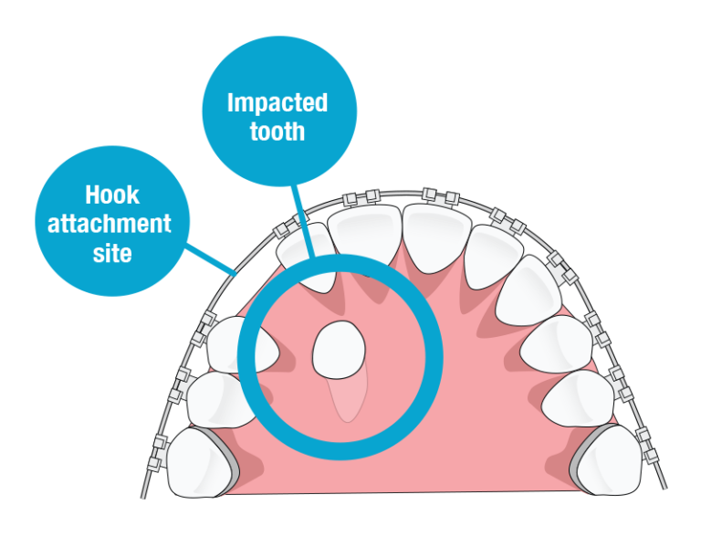 Instructions | Isoglide Eruption Spring