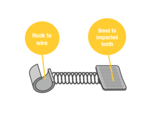 Instructions | Isoglide Eruption Spring