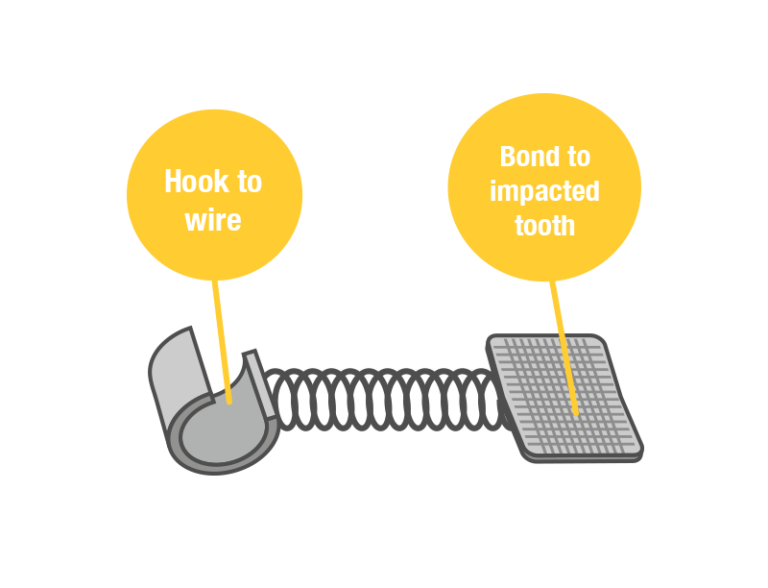 Instructions | Isoglide Eruption Spring